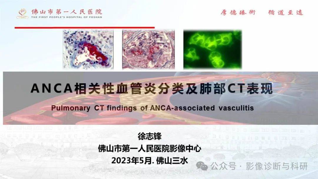 【PPT】ANCA相关性血管炎分类及肺部CT表现_临床_炎症_免疫