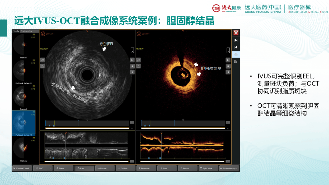 ICCD 2024 | 全球首个FDA获批的IVUS-OCT融合成像系统NOVASIGHT开启腔内影像新篇章_血管_技术_病变