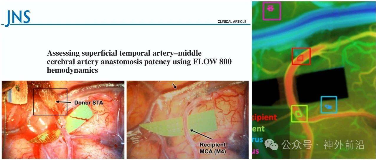 蔡司特约 | 美顶尖神外团队在JNS最新研究：应用FLOW800流速地图可指导脑血管搭桥部位选择和预测通畅性_血流_受体