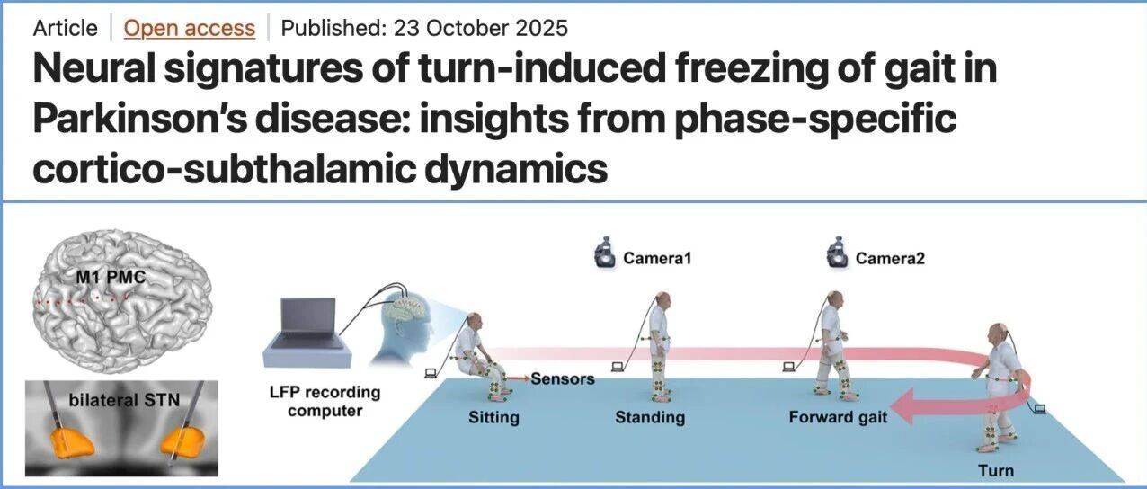 学术动态 | 天坛神外张建国团队报道发现干预帕金森病冻结步态的电生理生物标志物-NPJParkinsonsDis杂志_研究_Zhang_运动